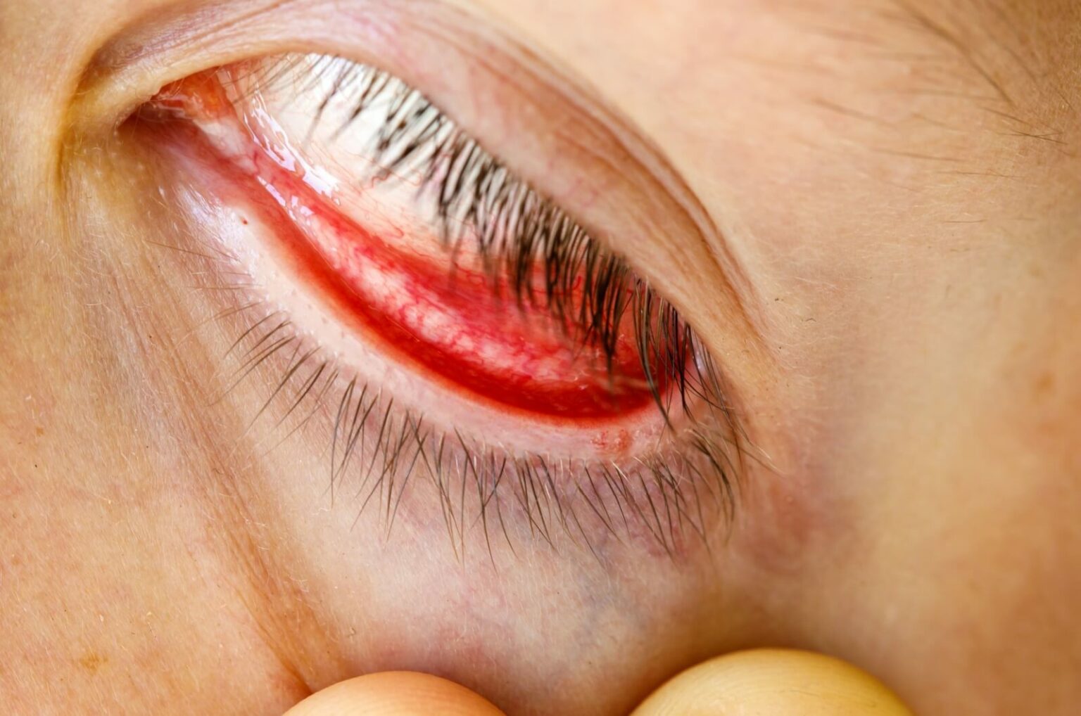 What to Do If You Have Blocked Meibomian Glands | Raleigh